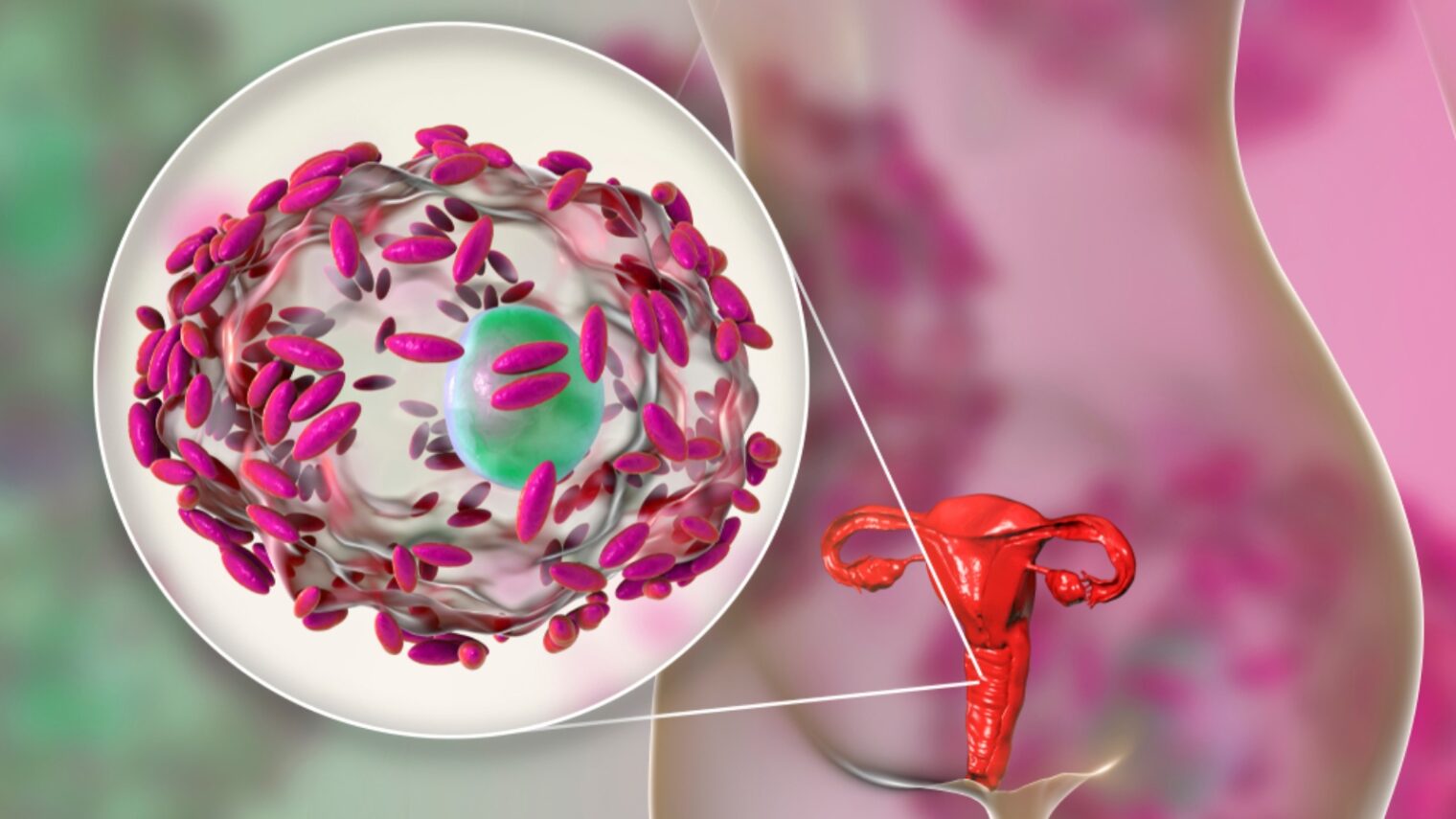 Pioneering treatment for chronic bacterial vaginosis - ISRAEL21c